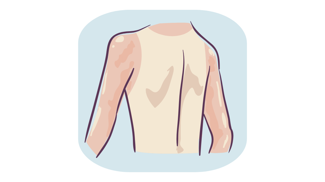 Cómo Aliviar las Quemaduras de Sol: 6 Remedios Económicos